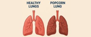 Popcorn Lung and Vaping: What You Need to Know - Quit Smoking Community